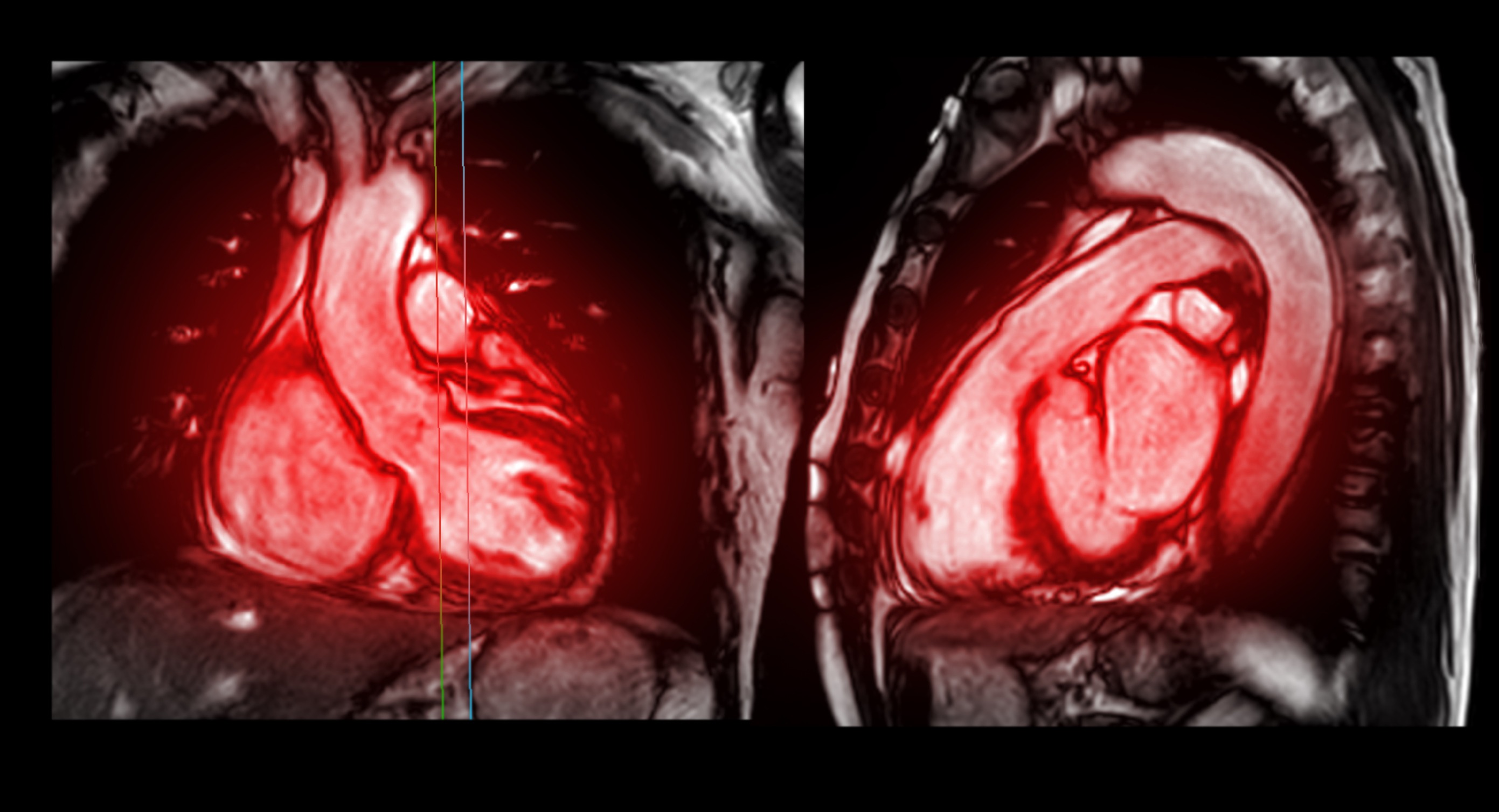New Technology May Find Early Signs of HCM – HCM Beat